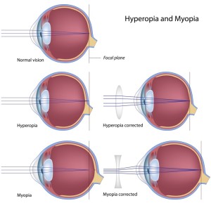 What Exactly Do Corrective Lenses Do? | Georgia Eye Physicians and Surgeons